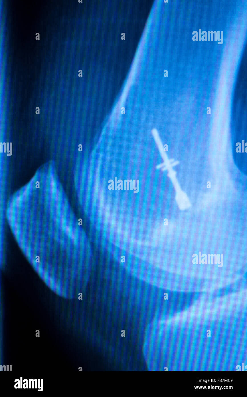 Knee joint meniscus x-ray test scan results photo showing injury and ...