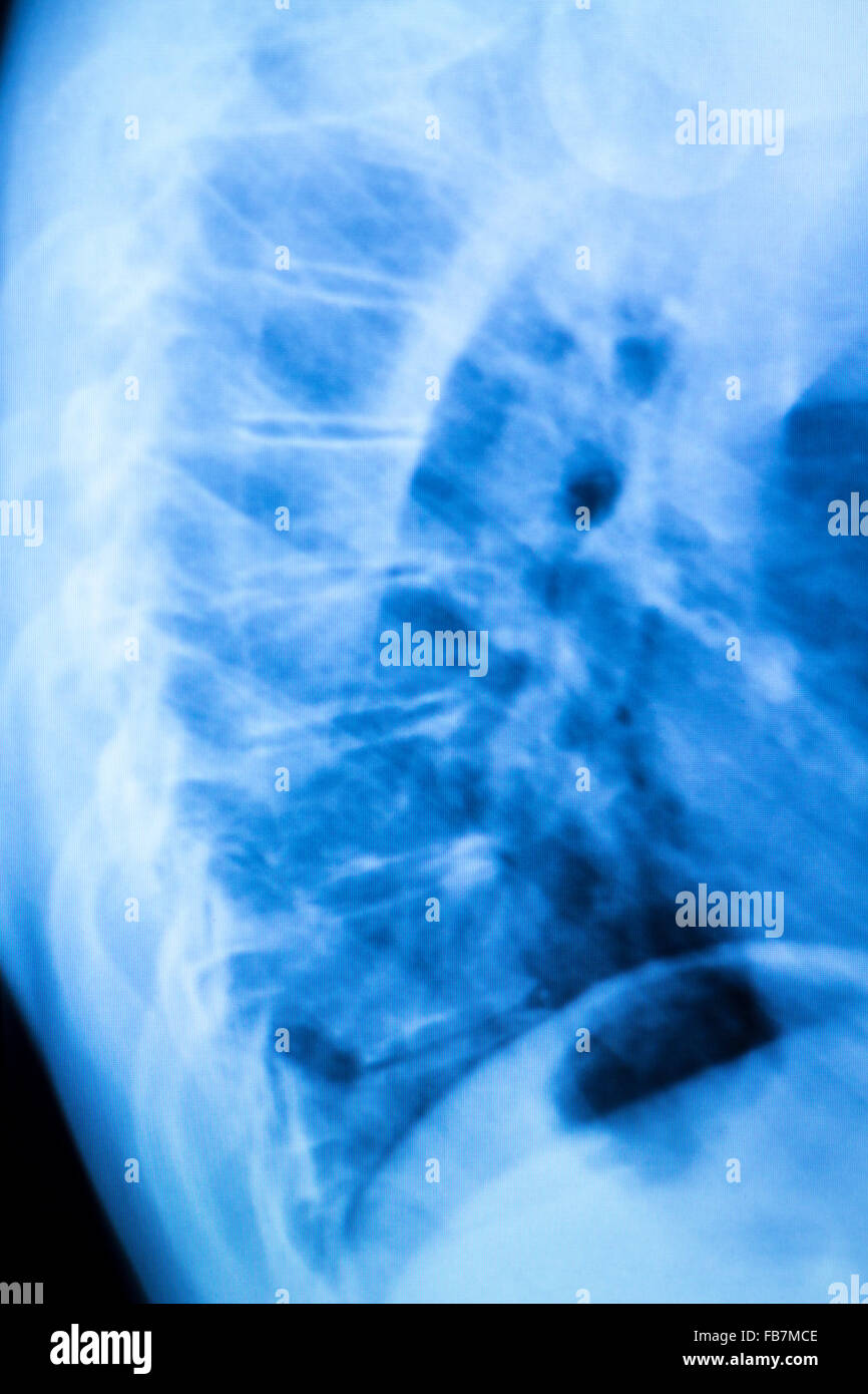 Painful neck and spine injury x-ray scan Traumatology and orthopedics ...