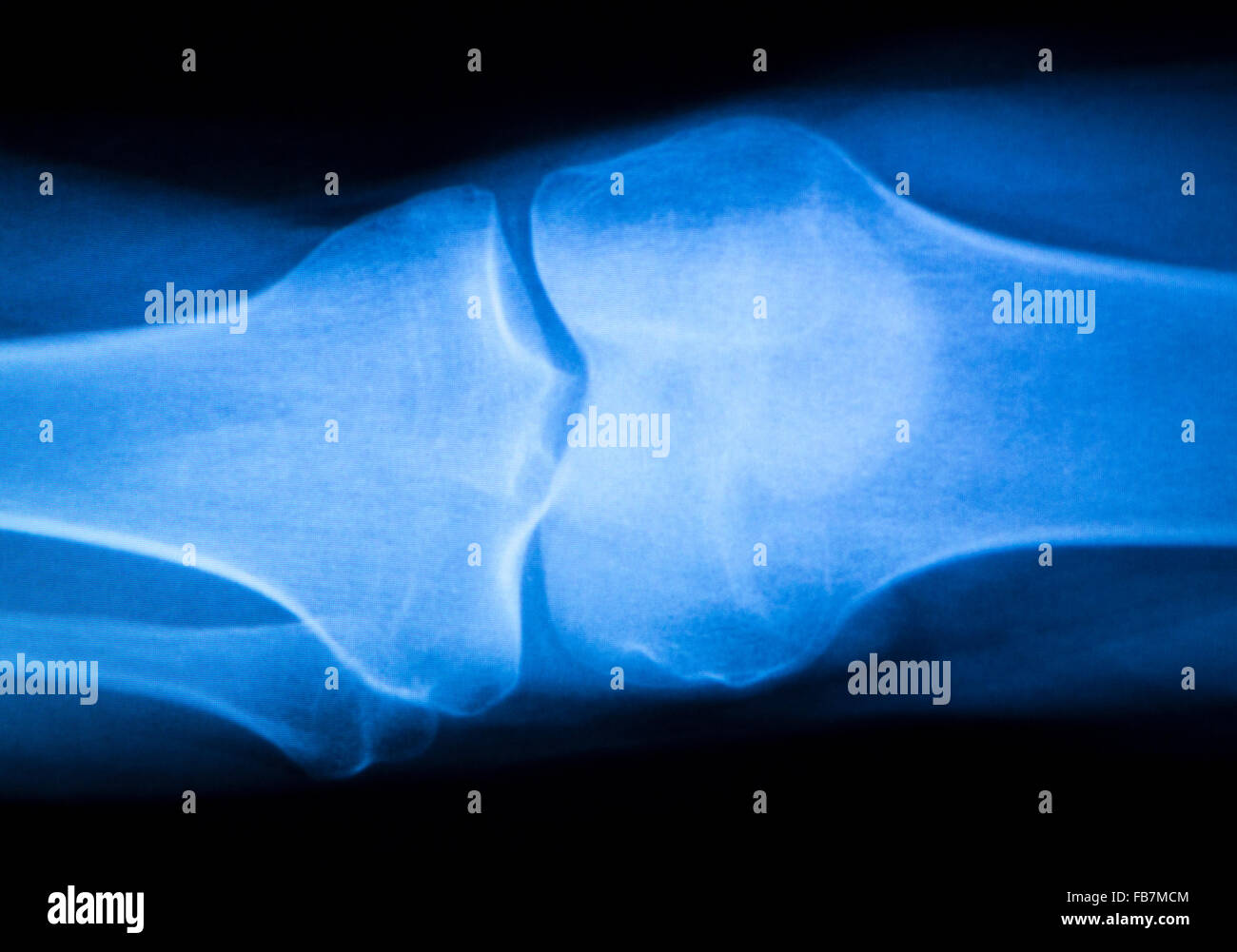 Knee joint meniscus x-ray test scan results photo showing injury and ...