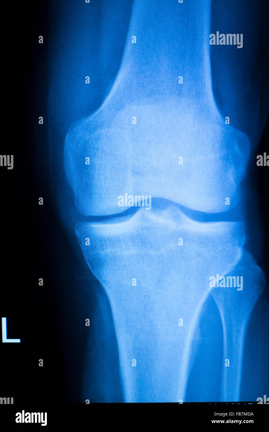 Knee joint meniscus x-ray test scan results photo showing injury and ...