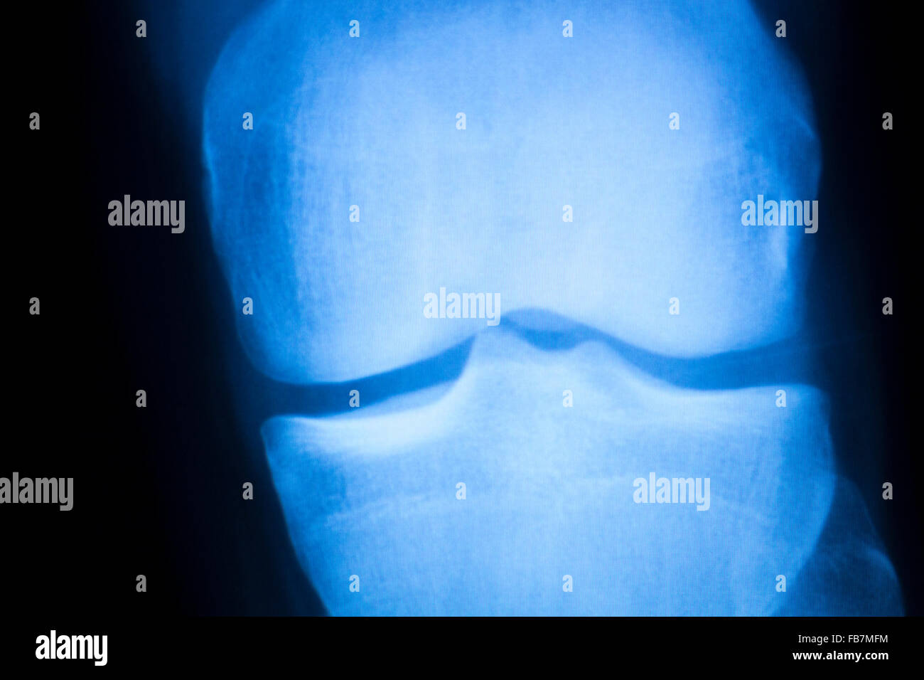 Knee joint meniscus x-ray test scan results photo showing injury and ...