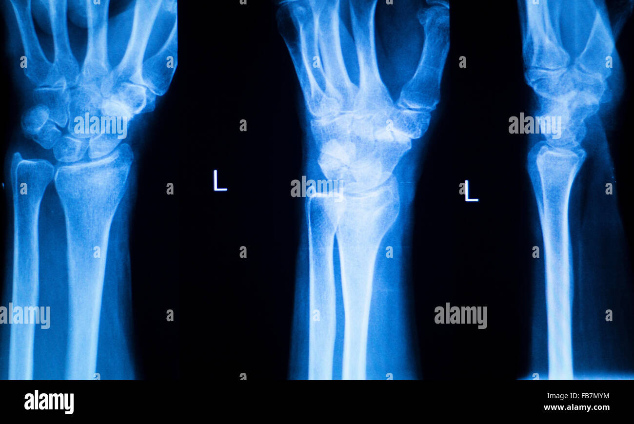 Hand, fingers and thumb hospital x-ray scan test results for joint pain ...