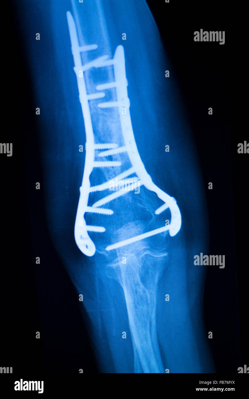 Othopedics and Traumatology surgical implant arm and elbow xray test ...