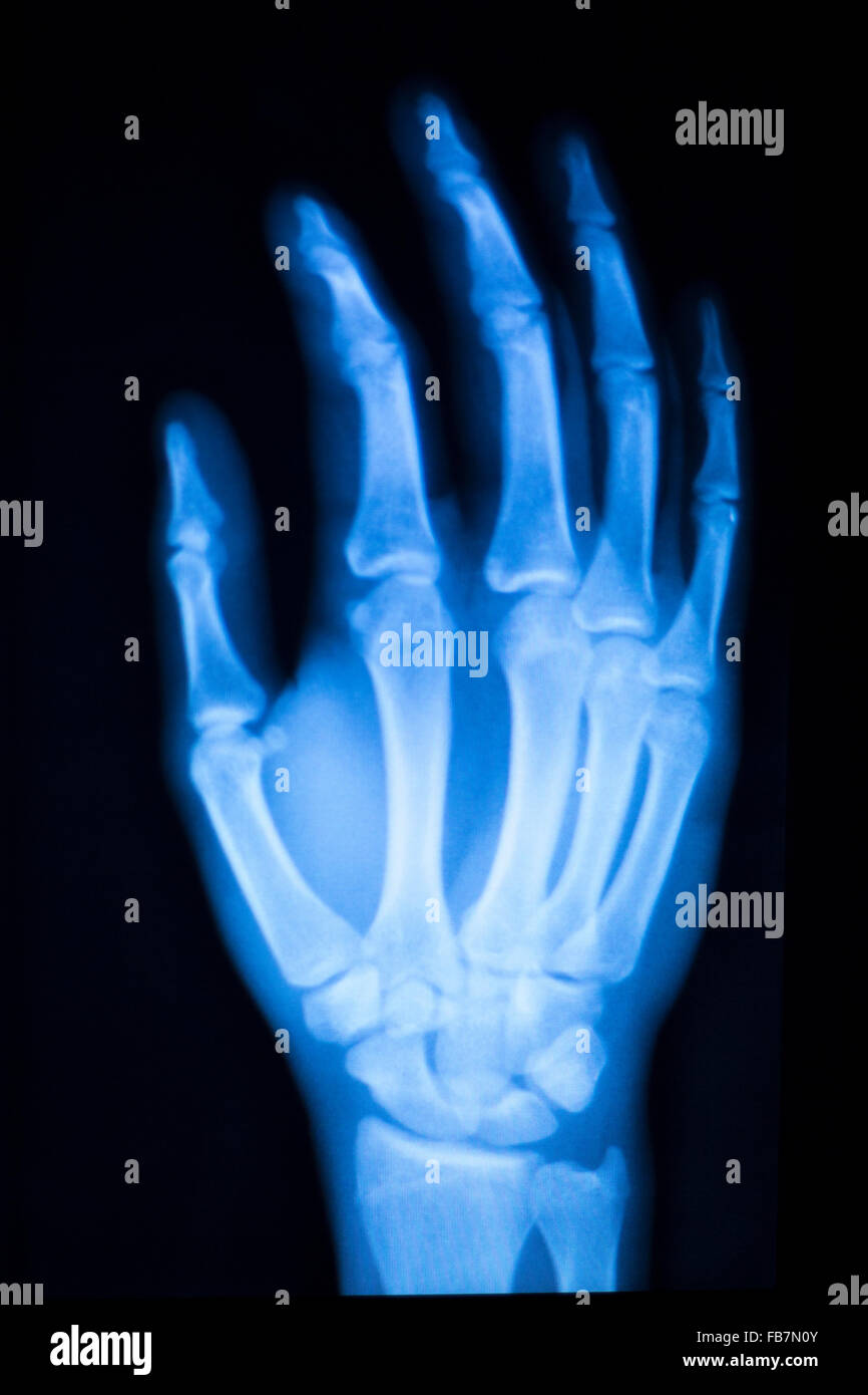 Hand, fingers and thumb hospital x-ray scan test results for joint pain ...