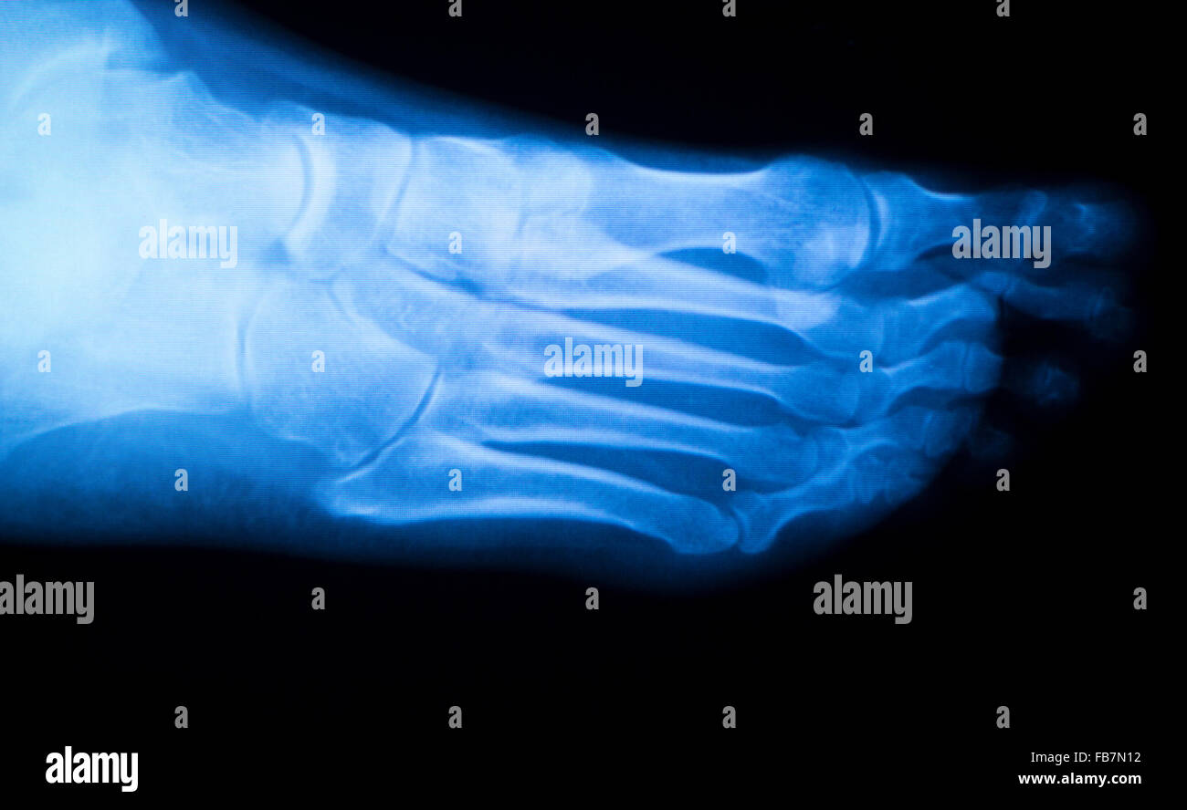 Foot and toes injury x-ray scan orthopedics and Traumatology radiology ...