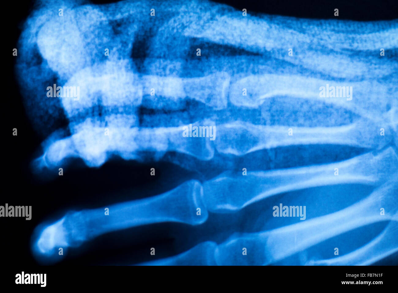 Foot and toes injury x-ray scan orthopedics and Traumatology radiology ...