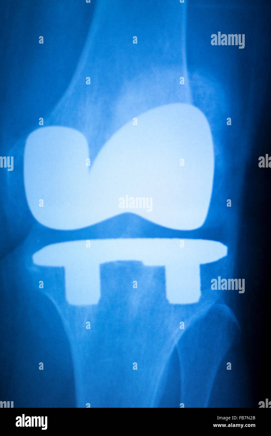 Knee joint meniscus x-ray test scan results photo showing injury and ...