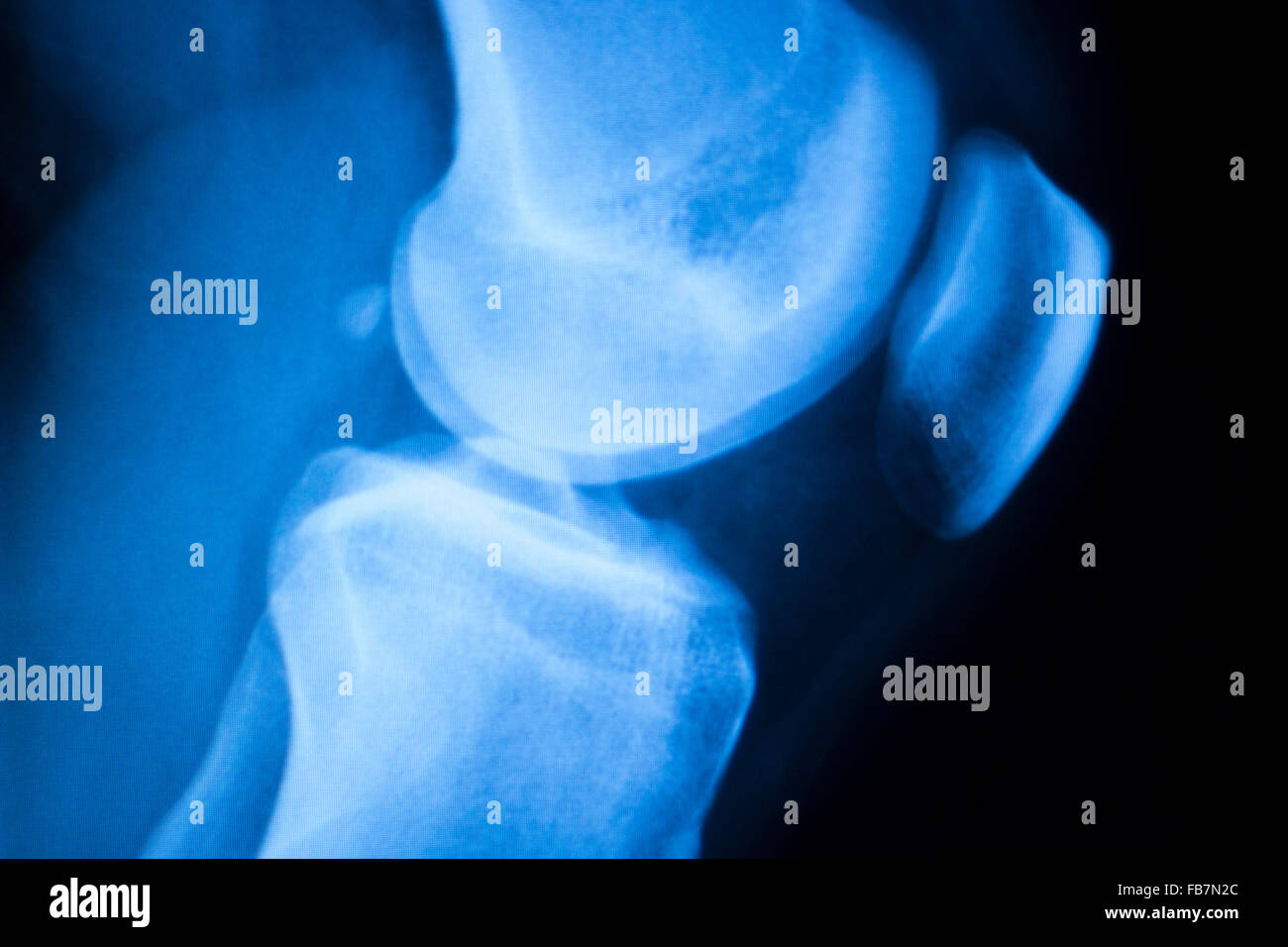Knee joint meniscus x-ray test scan results photo showing injury and ...