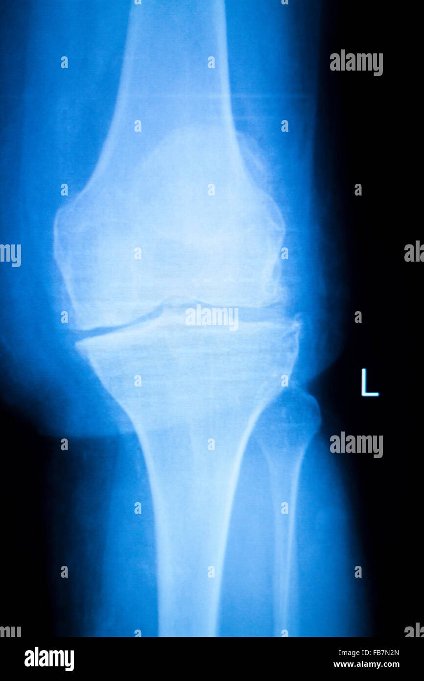 Knee joint meniscus x-ray test scan results photo showing injury and ...