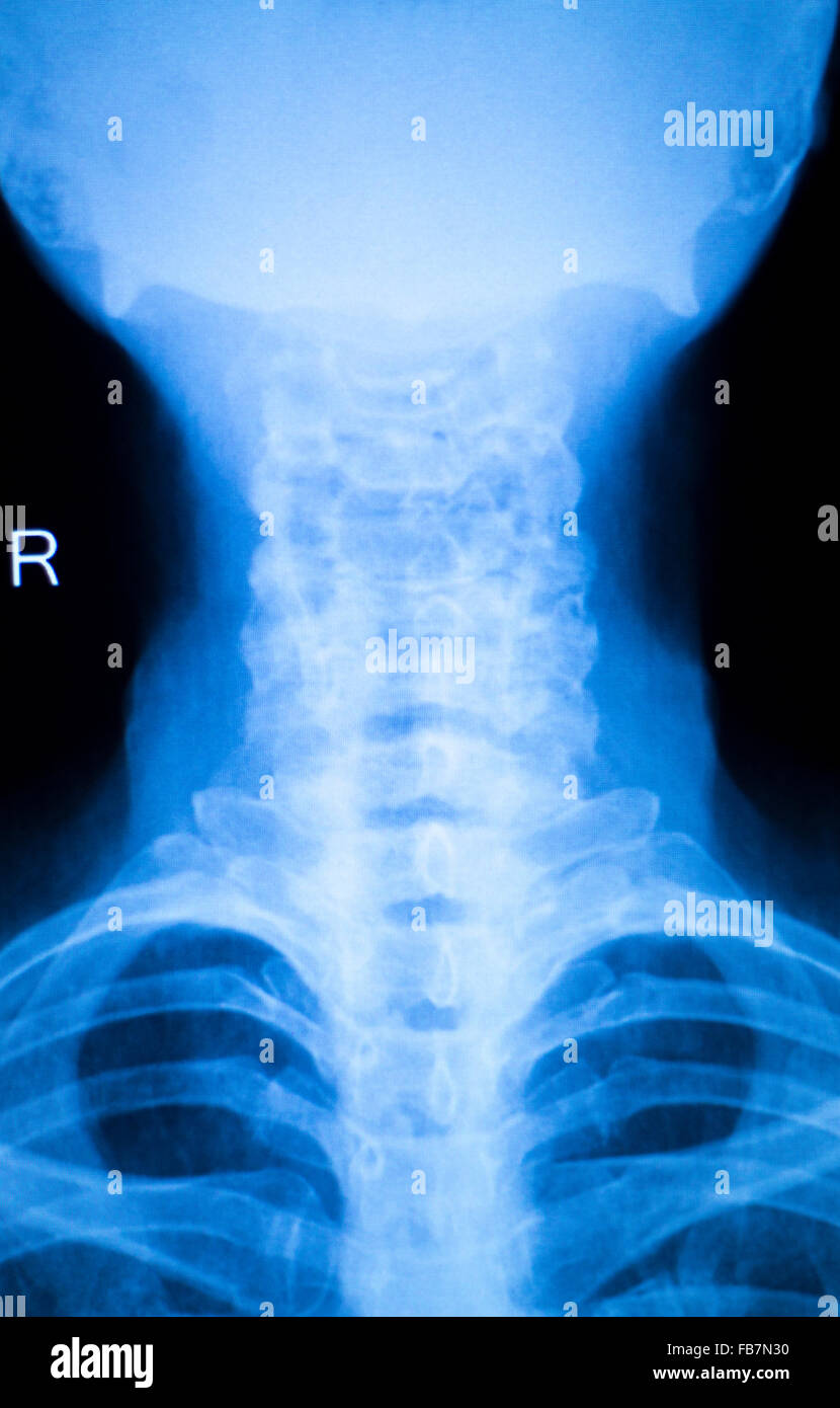 Painful neck and spine injury x-ray scan Traumatology and orthopedics ...