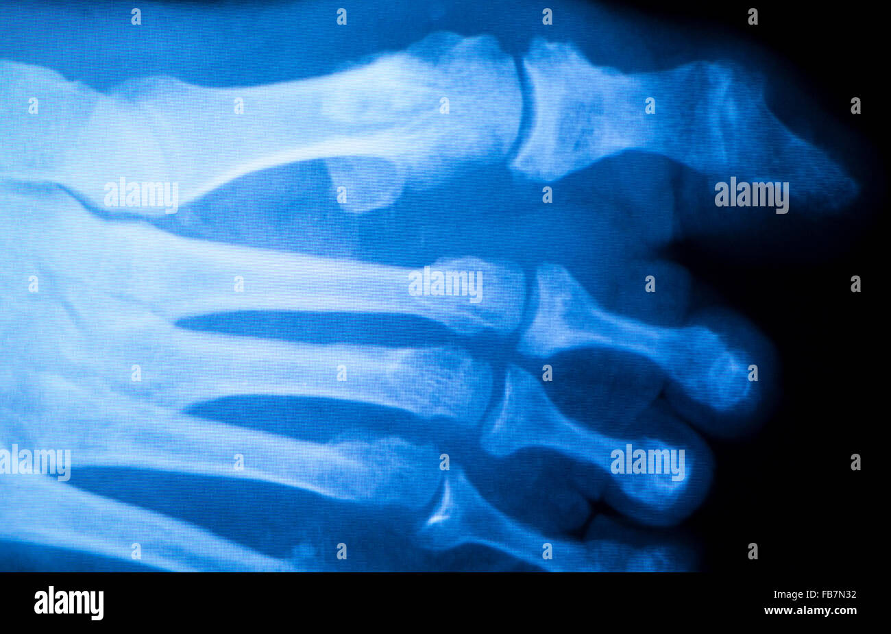 Foot and toes injury x-ray scan orthopedics and Traumatology radiology ...