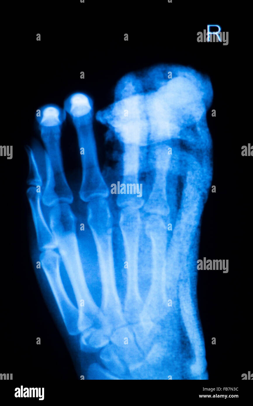 Hand, fingers and thumb hospital x-ray scan test results for joint pain ...