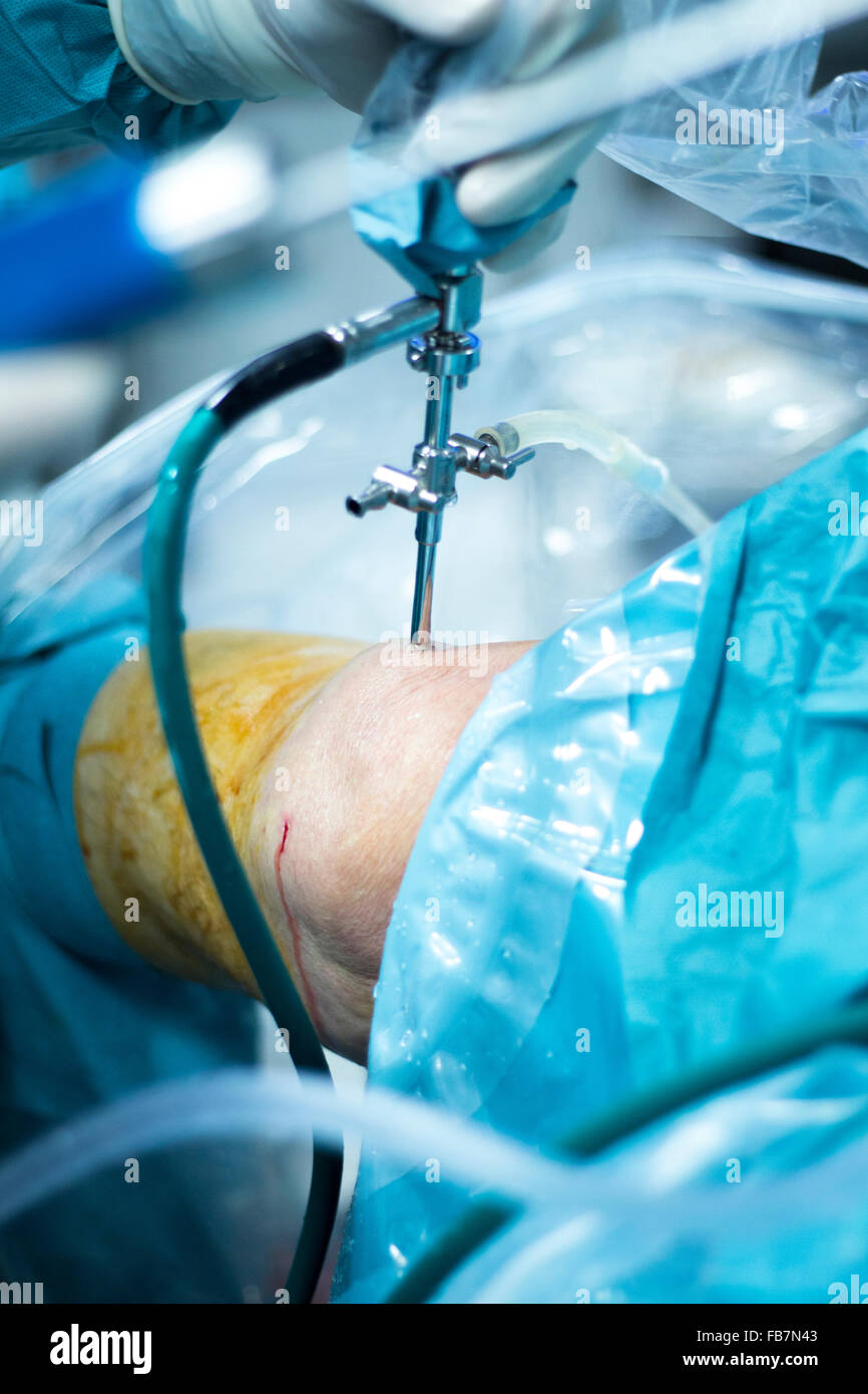 Knee arthroscopy orthopedic surgery operation in hospital operating ...