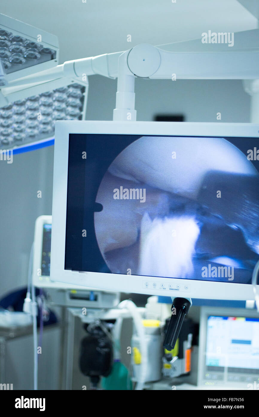 Hospital keyhole micro surgery arthroscopy operation screen showing ...