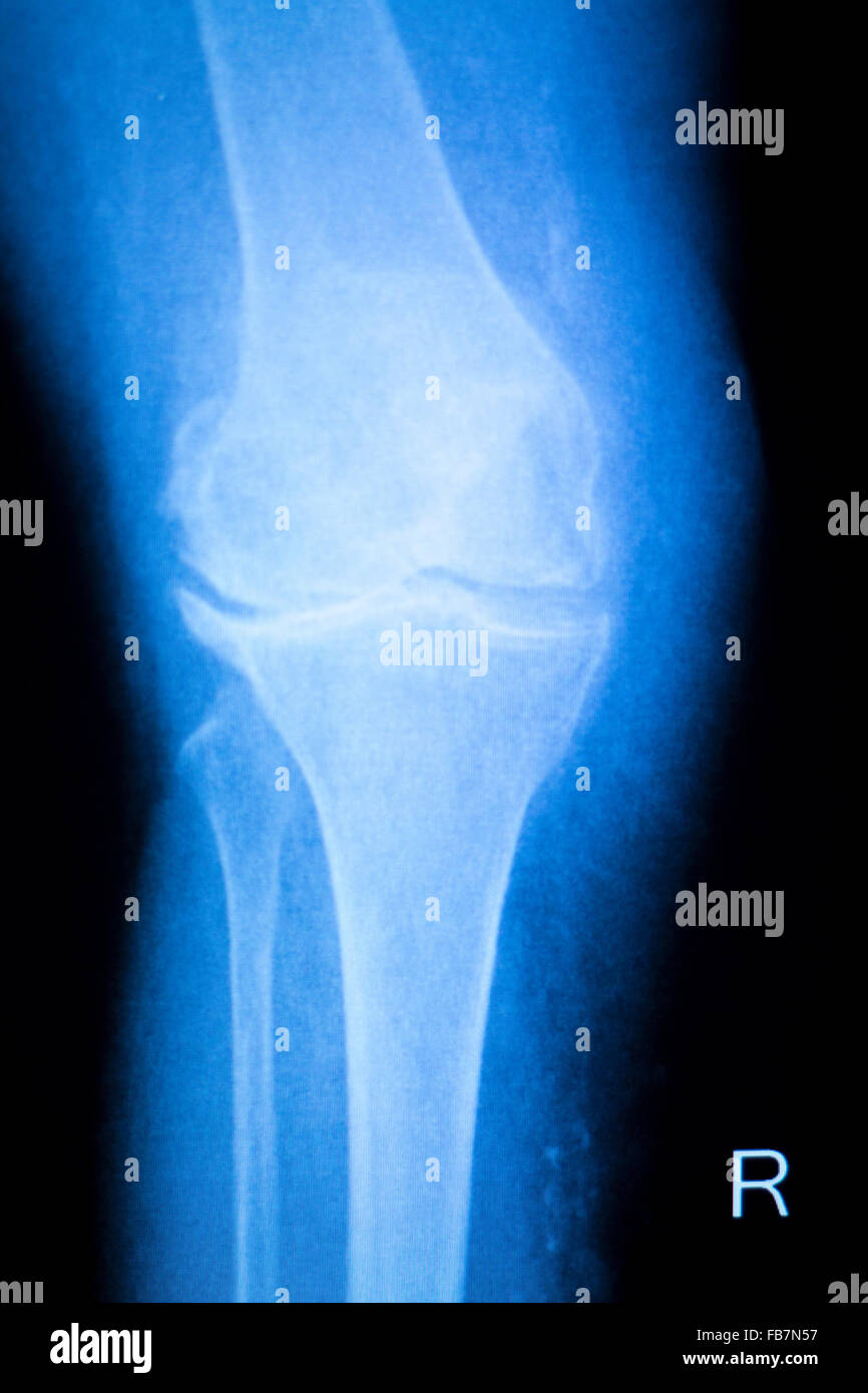 Knee joint meniscus x-ray test scan results photo showing injury and ...