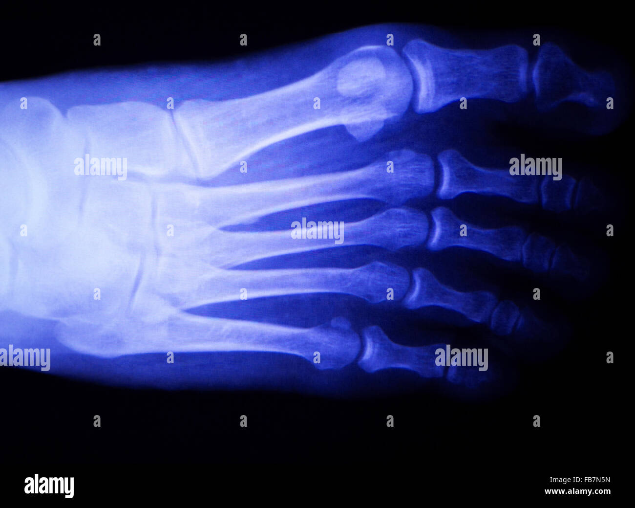 Foot and toes injury x-ray scan orthopedics and Traumatology radiology ...