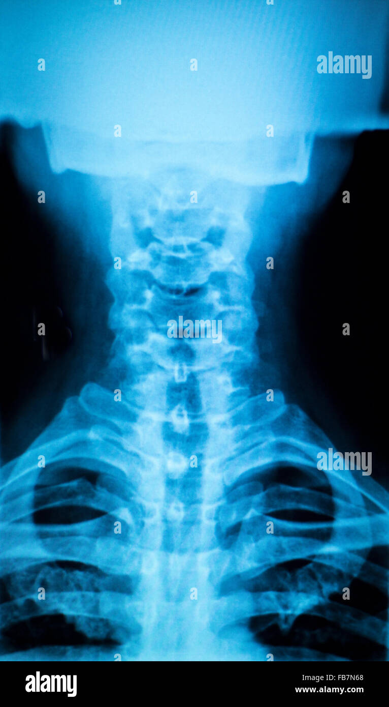Painful neck and spine injury x-ray scan Traumatology and orthopedics ...