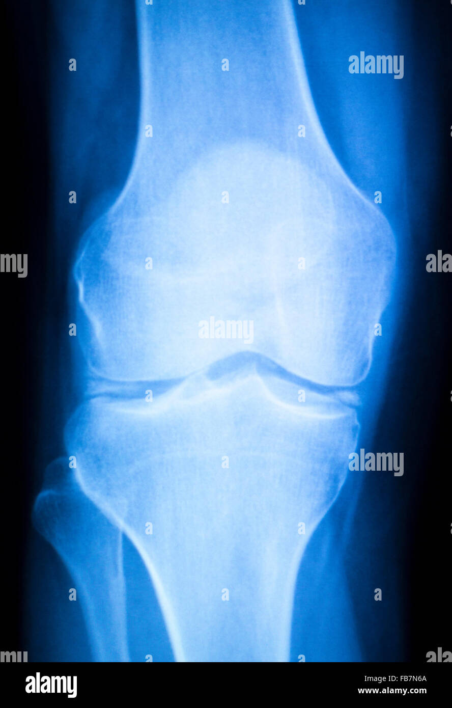 Knee joint meniscus x-ray test scan results photo showing injury and ...