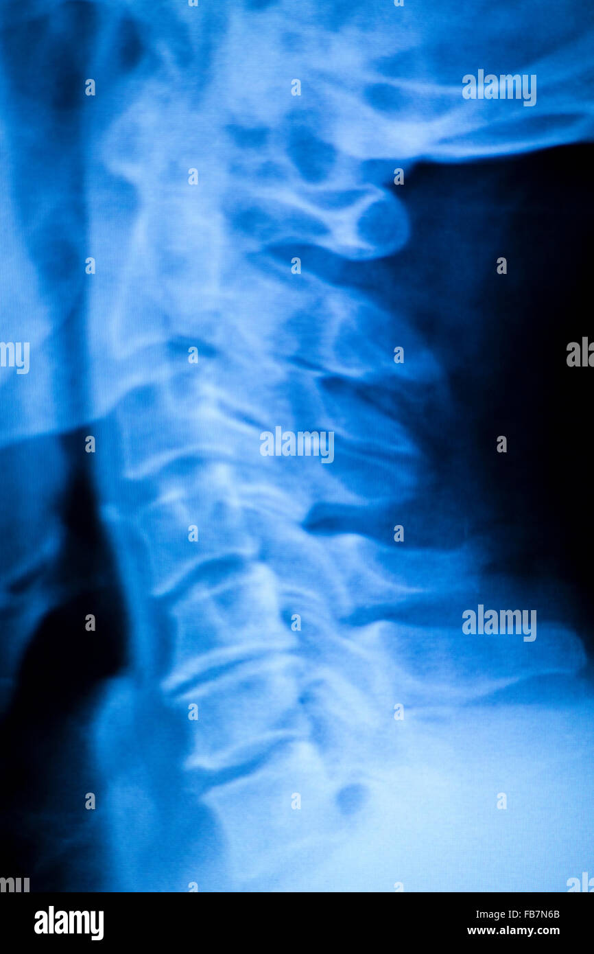 Painful neck and spine injury x-ray scan Traumatology and orthopedics ...