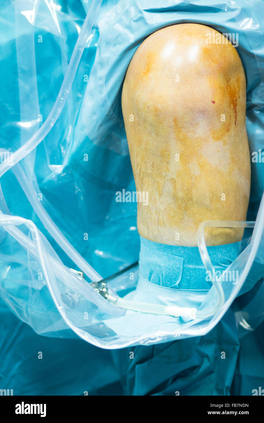 Hospital orthopedic traumatology leg surgery operating room photo Stock ...