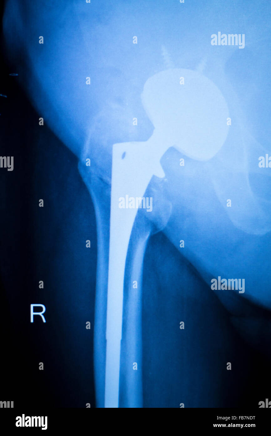 Hip replacement xray hi-res stock photography and images - Alamy