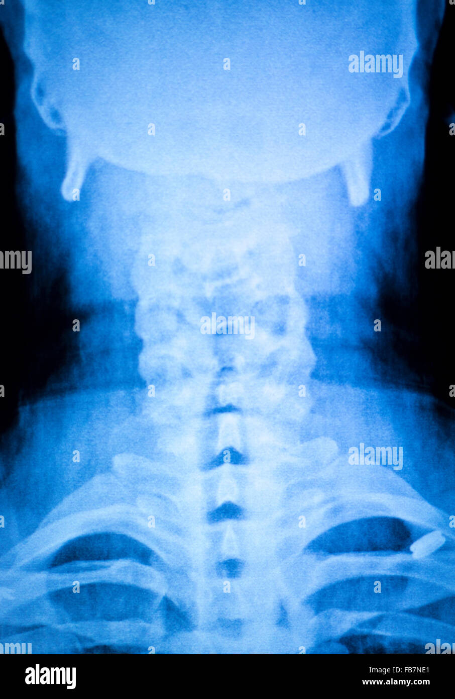 Painful neck and spine injury x-ray scan Traumatology and orthopedics ...