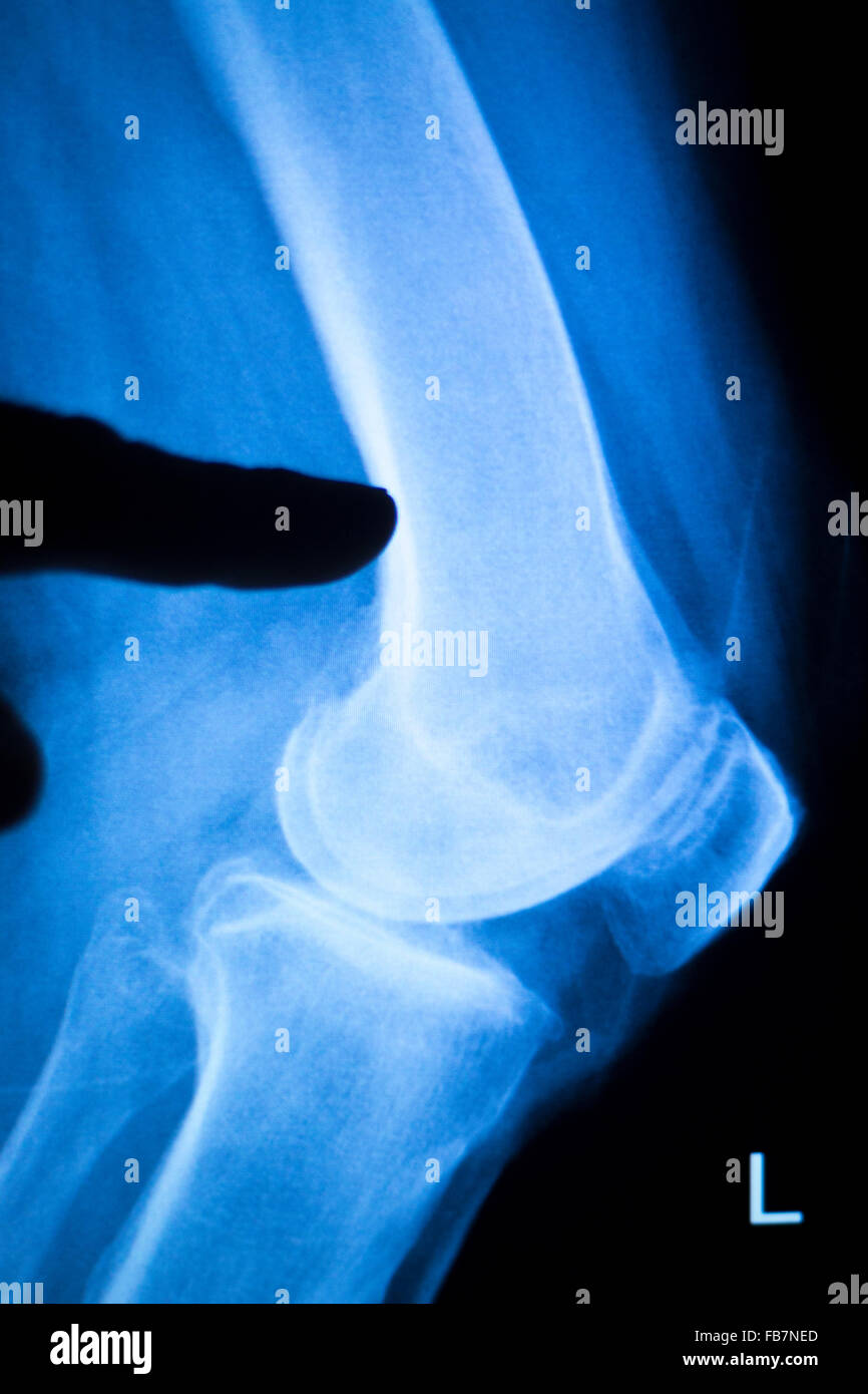 Knee joint meniscus x-ray test scan results photo showing injury and ...