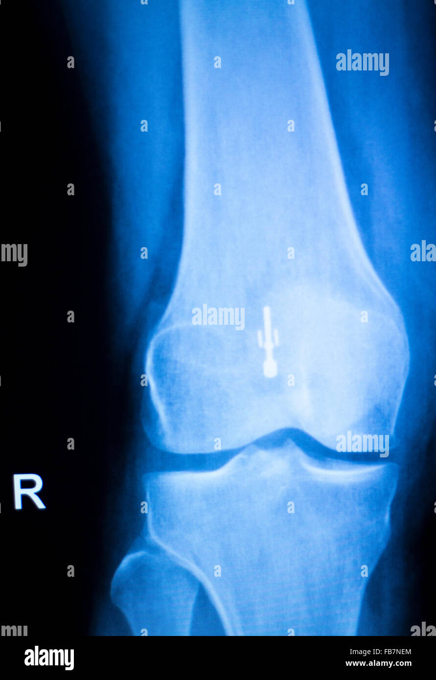 Knee joint meniscus x-ray test scan results photo showing injury and ...