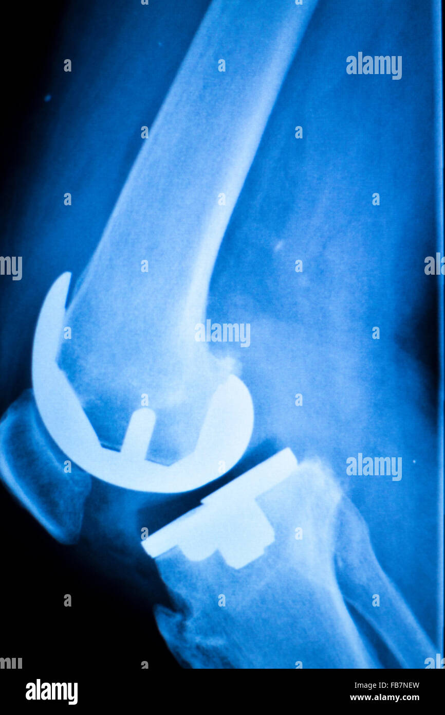 Knee joint meniscus x-ray test scan results photo showing injury and ...