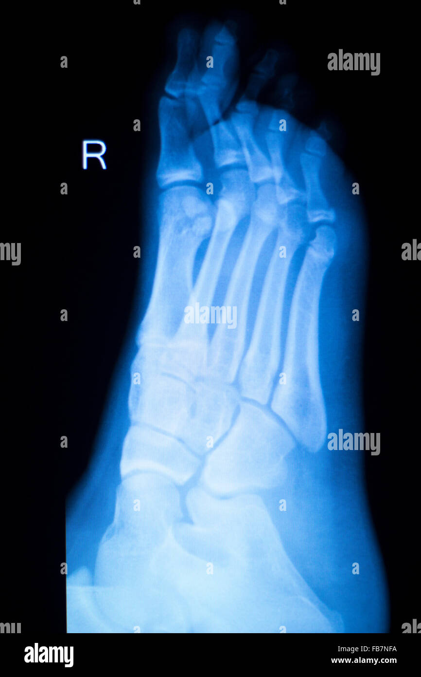 Foot and toes injury x-ray scan orthopedics and Traumatology radiology ...
