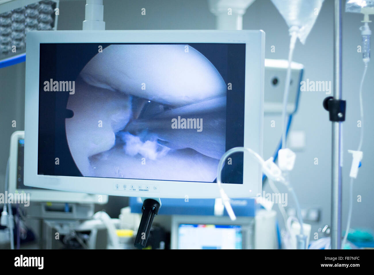 Hospital keyhole micro surgery arthroscopy operation screen showing ...