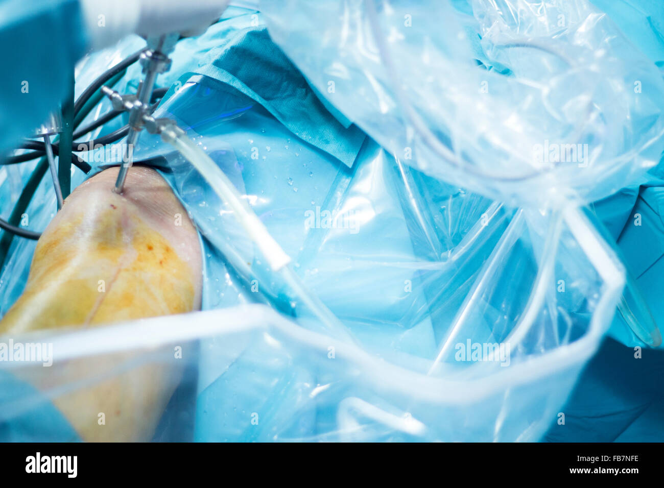 Knee arthroscopy orthopedic surgery operation in hospital operating ...