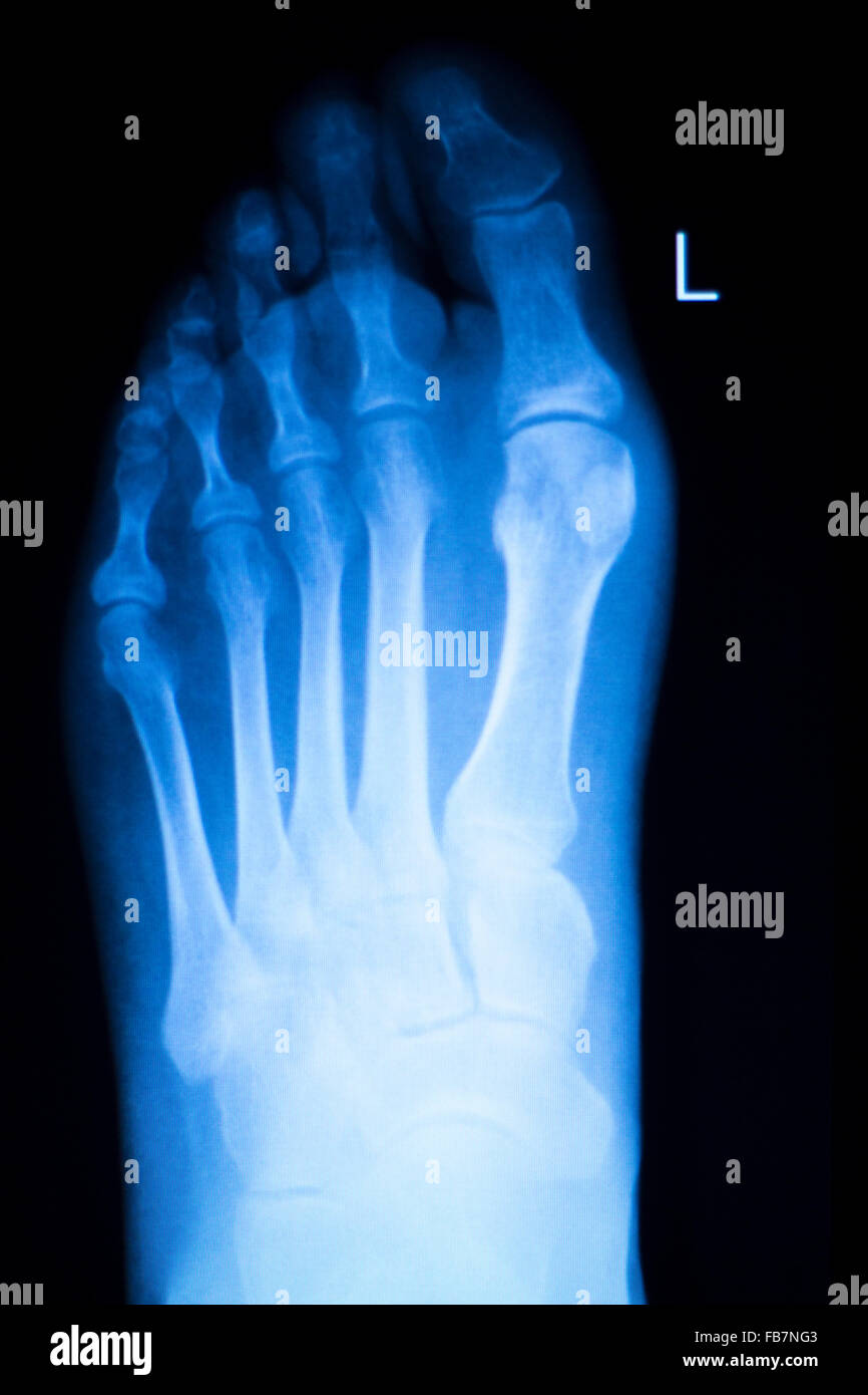 Foot and toes injury x-ray scan orthopedics and Traumatology radiology ...
