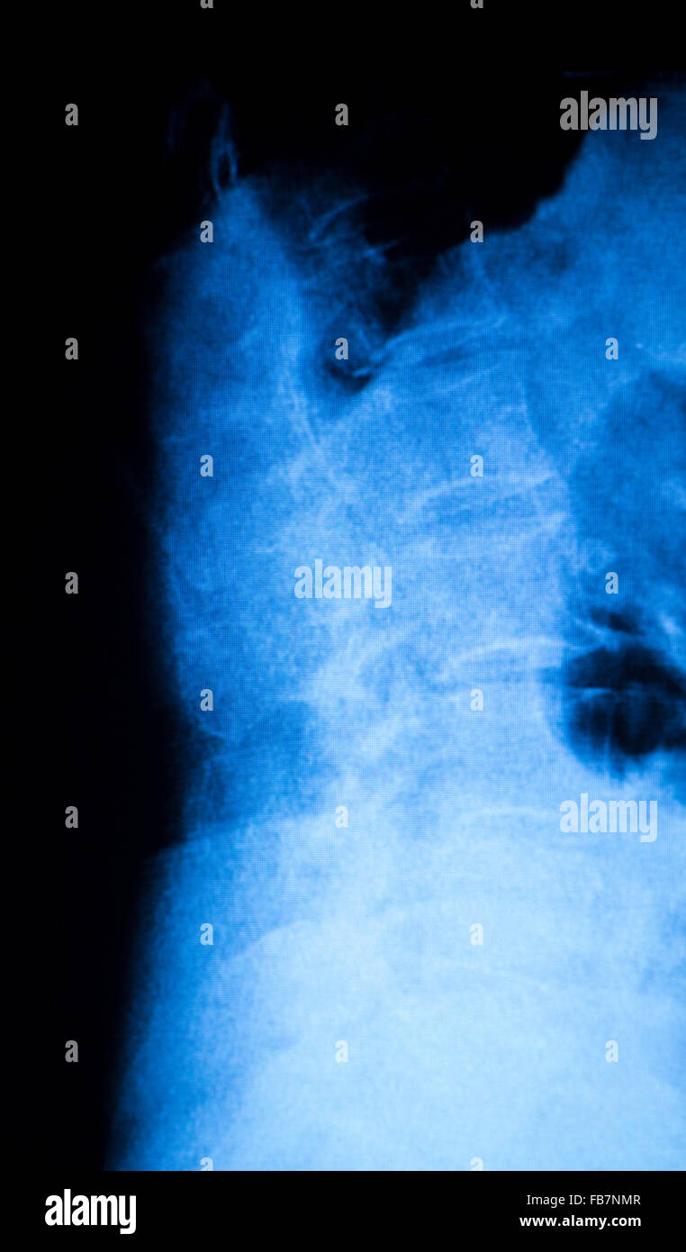 Painful neck and spine injury x-ray scan Traumatology and orthopedics ...