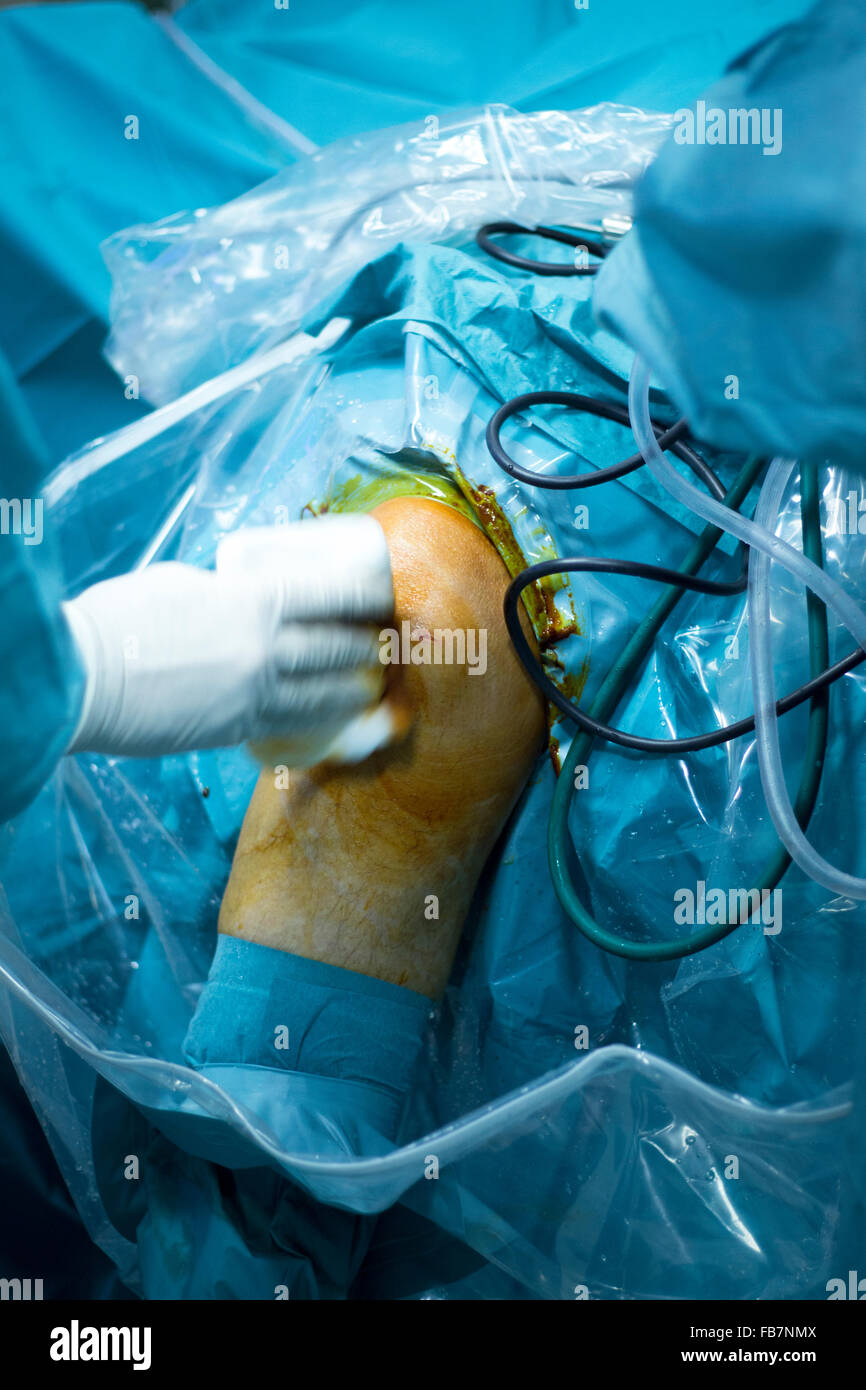 Knee arthroscopy orthopedic surgery operation in hospital emergency ...