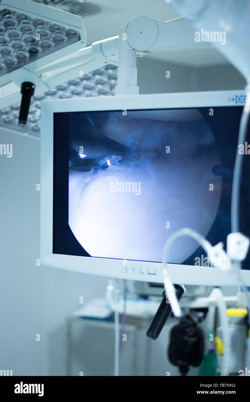 Hospital keyhole micro surgery arthroscopy operation screen showing ...