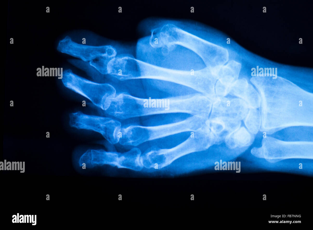 Hand, fingers and thumb hospital x-ray scan test results for joint pain ...