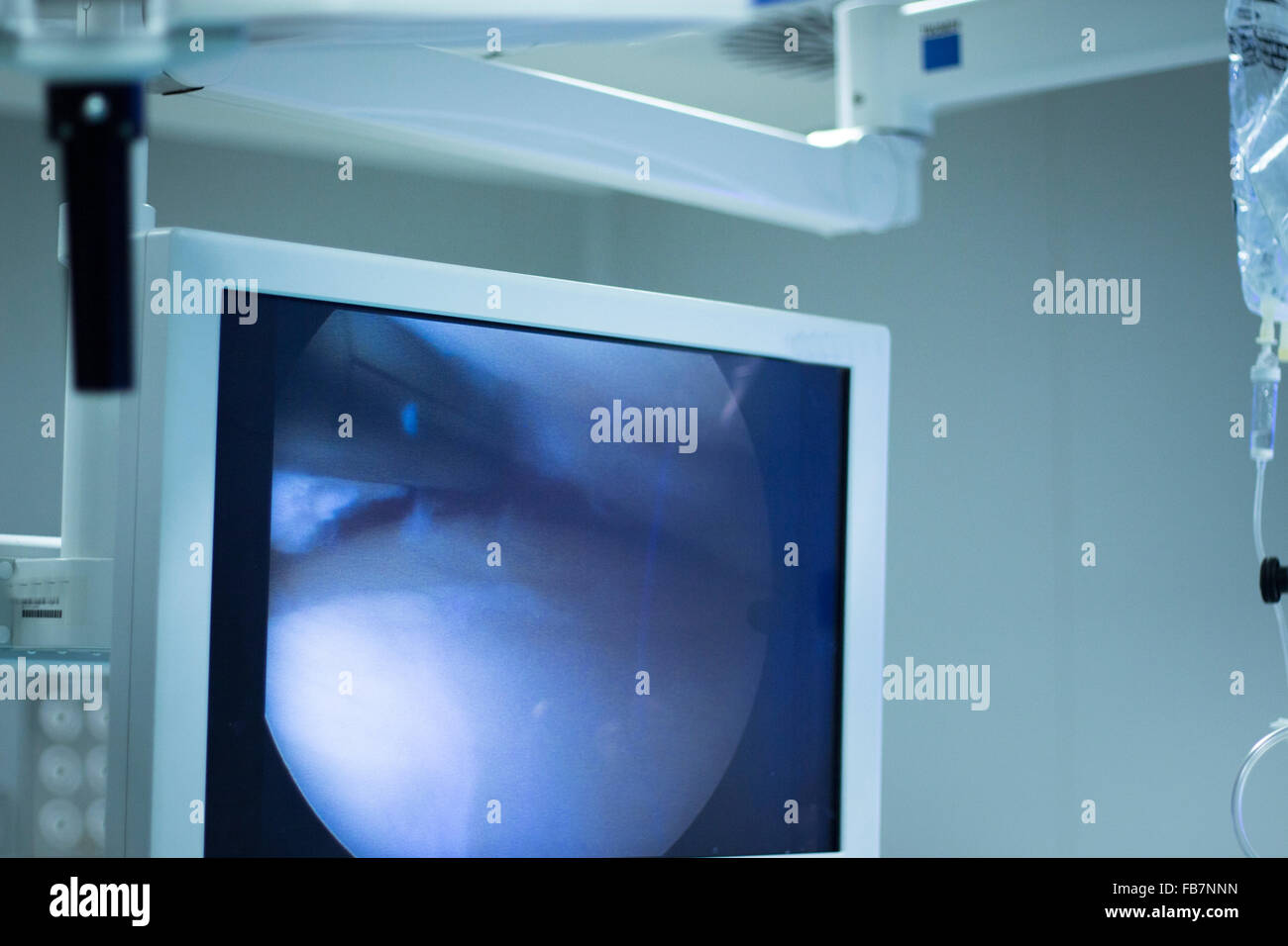 Hospital keyhole micro surgery arthroscopy operation screen showing ...