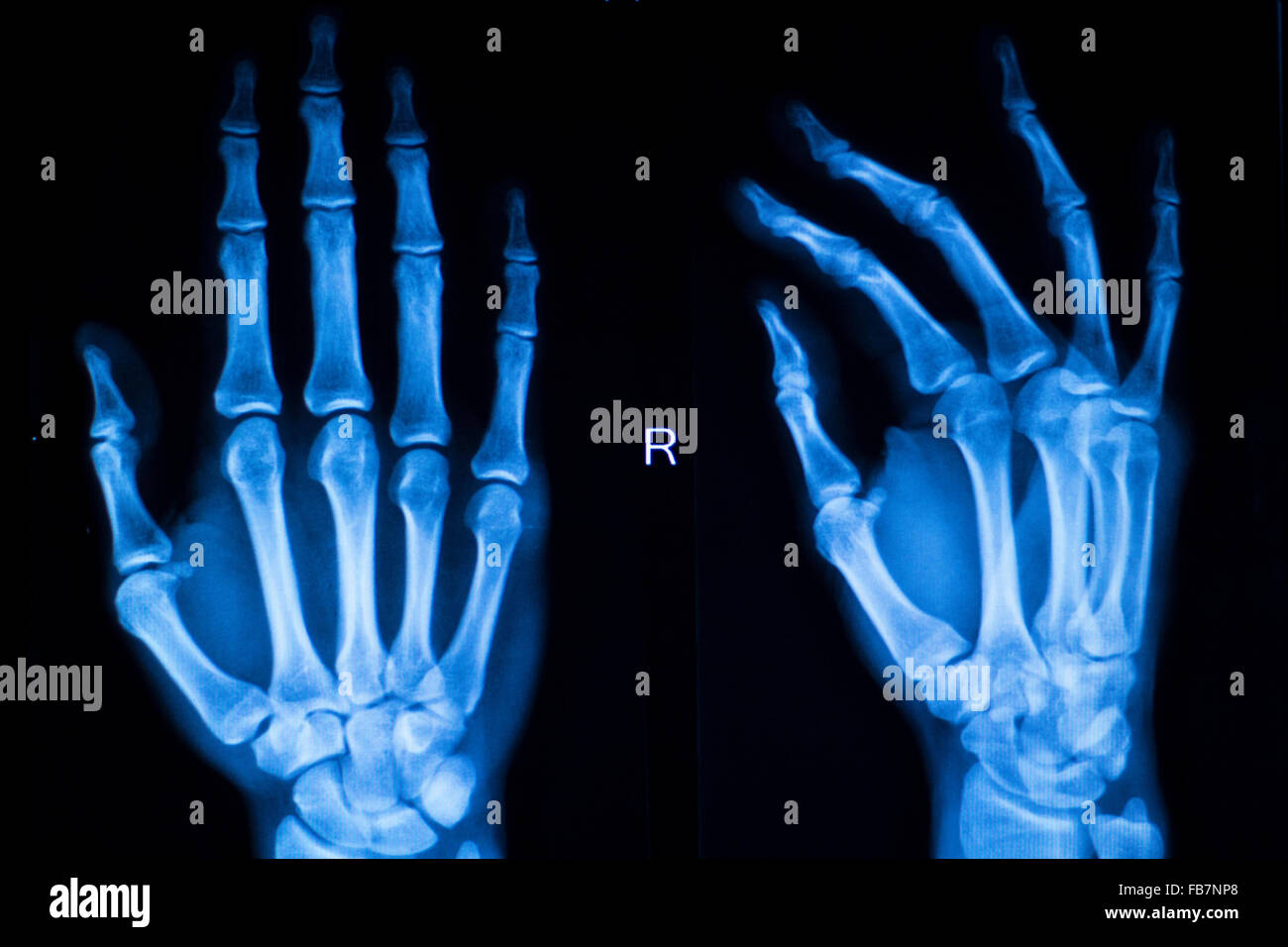 Hand, fingers and thumb hospital x-ray scan test results for joint pain ...