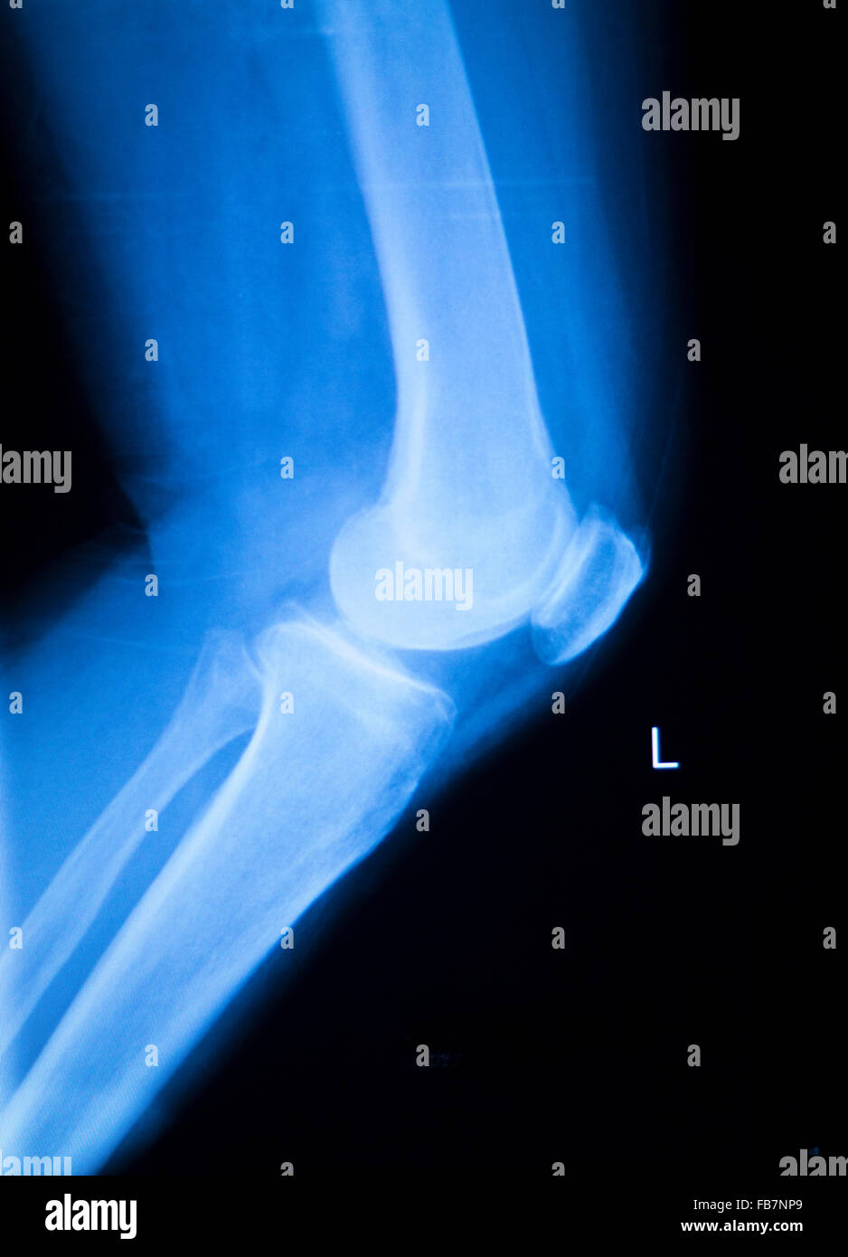 Knee joint meniscus x-ray test scan results photo showing injury and ...
