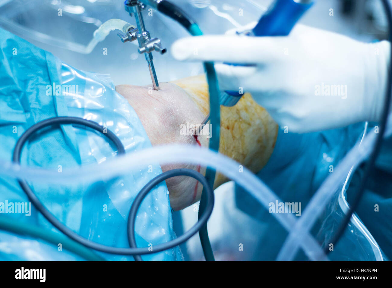 Knee arthroscopy orthopedic surgery operation in hospital operating ...
