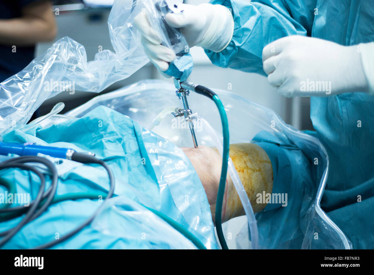 Knee arthroscopy orthopedic surgery operation in hospital operating ...