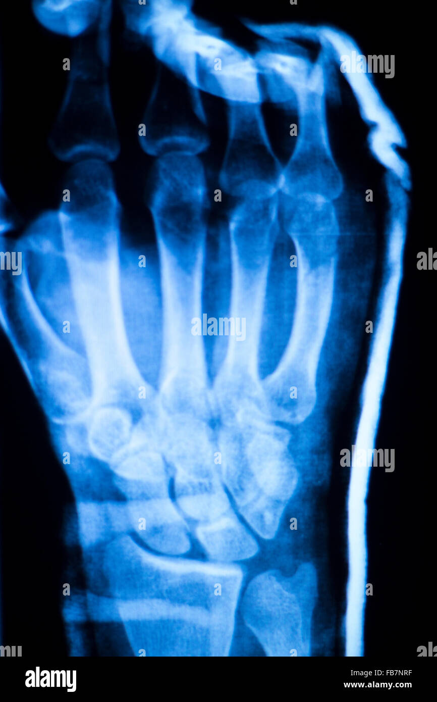 Hand, fingers and thumb hospital x-ray scan test results for joint pain ...