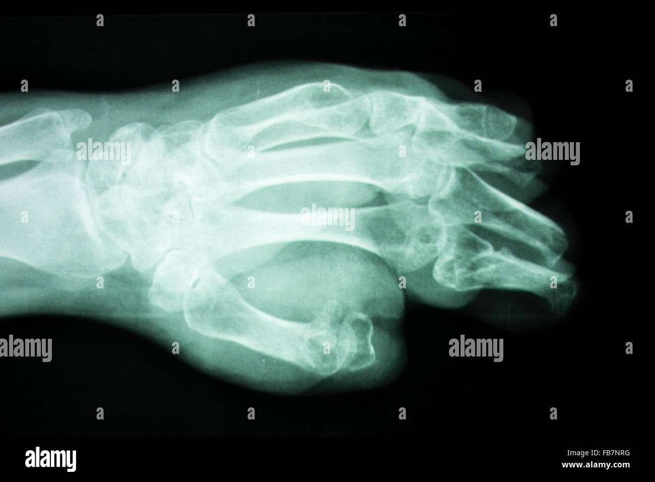 Hand, fingers and thumb hospital x-ray scan test results for joint pain ...