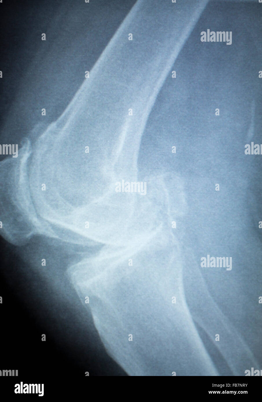 Knee joint meniscus x-ray test scan results photo showing injury and ...