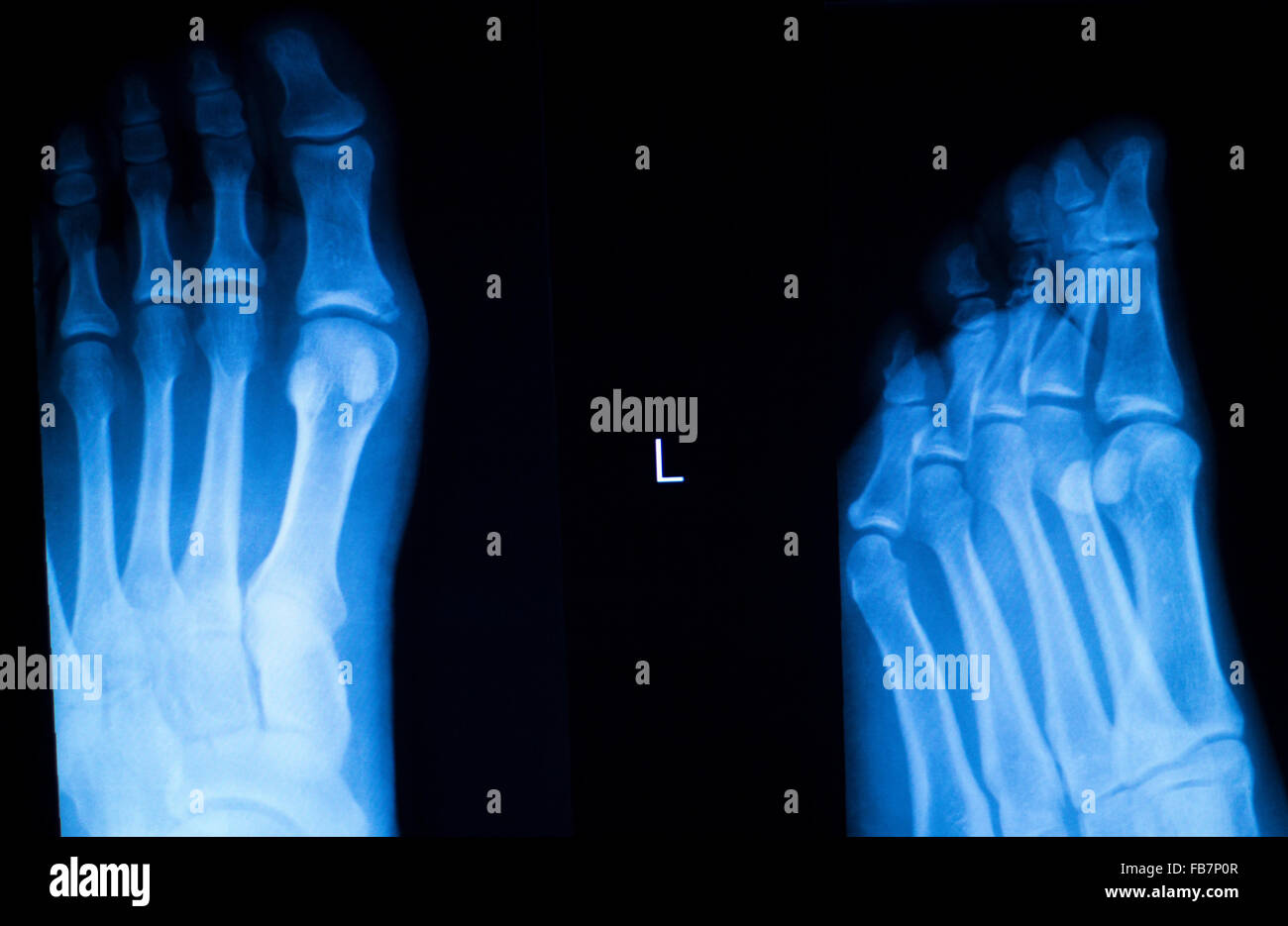 Foot and toes injury x-ray scan orthopedics and Traumatology radiology ...