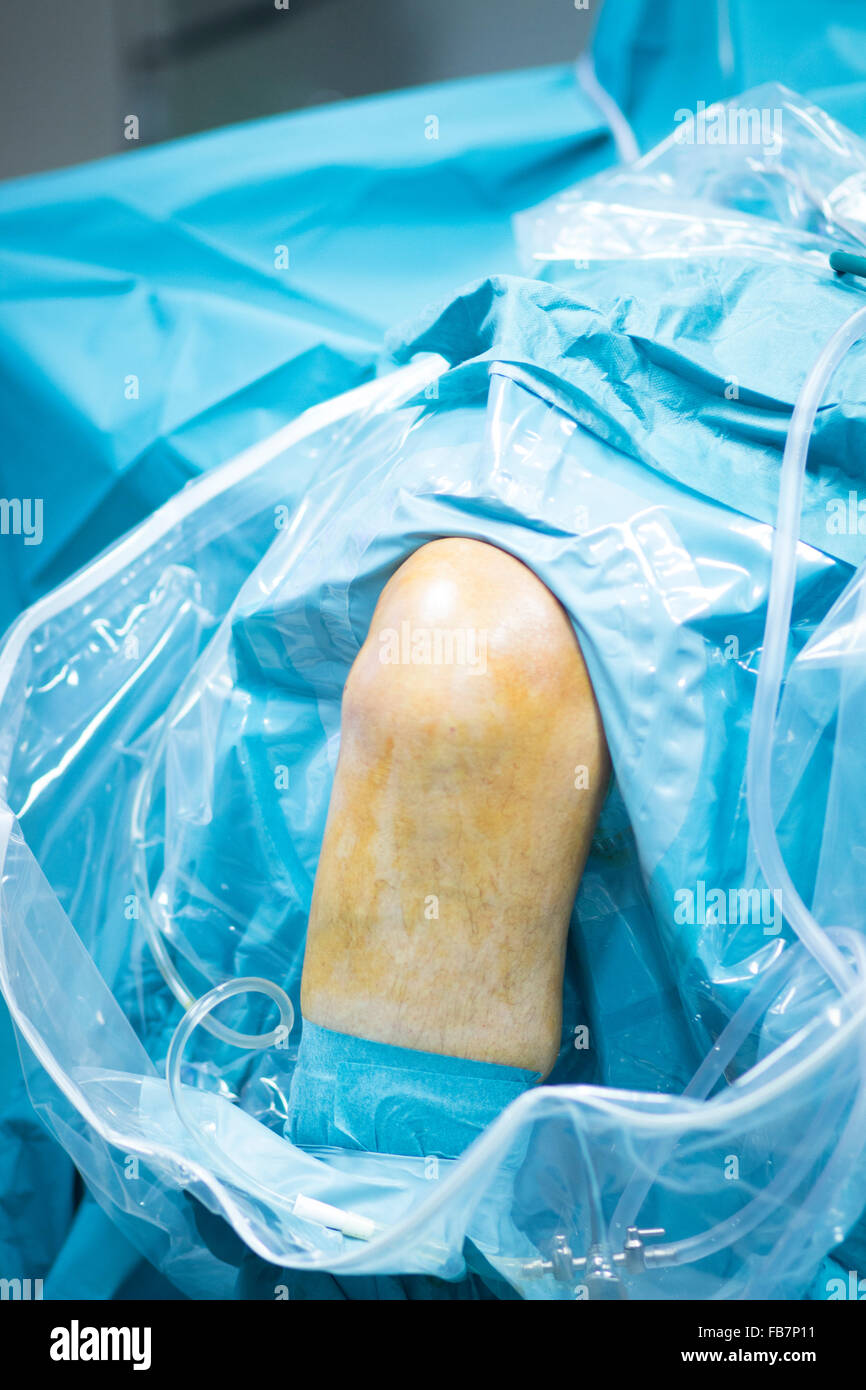 Hospital orthopedic traumatology leg surgery operating room photo Stock ...