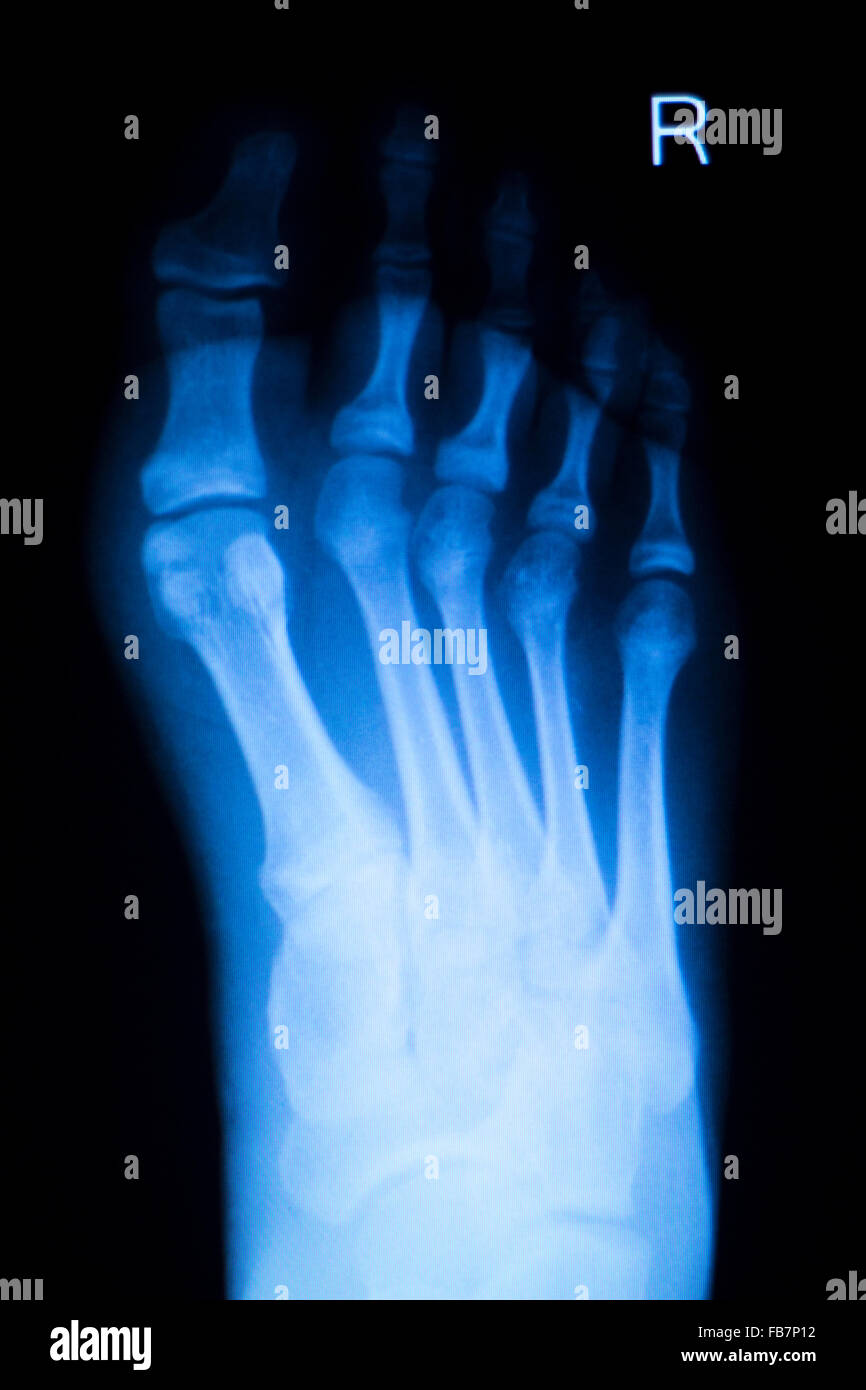 Foot and toes injury x-ray scan orthopedics and Traumatology radiology ...