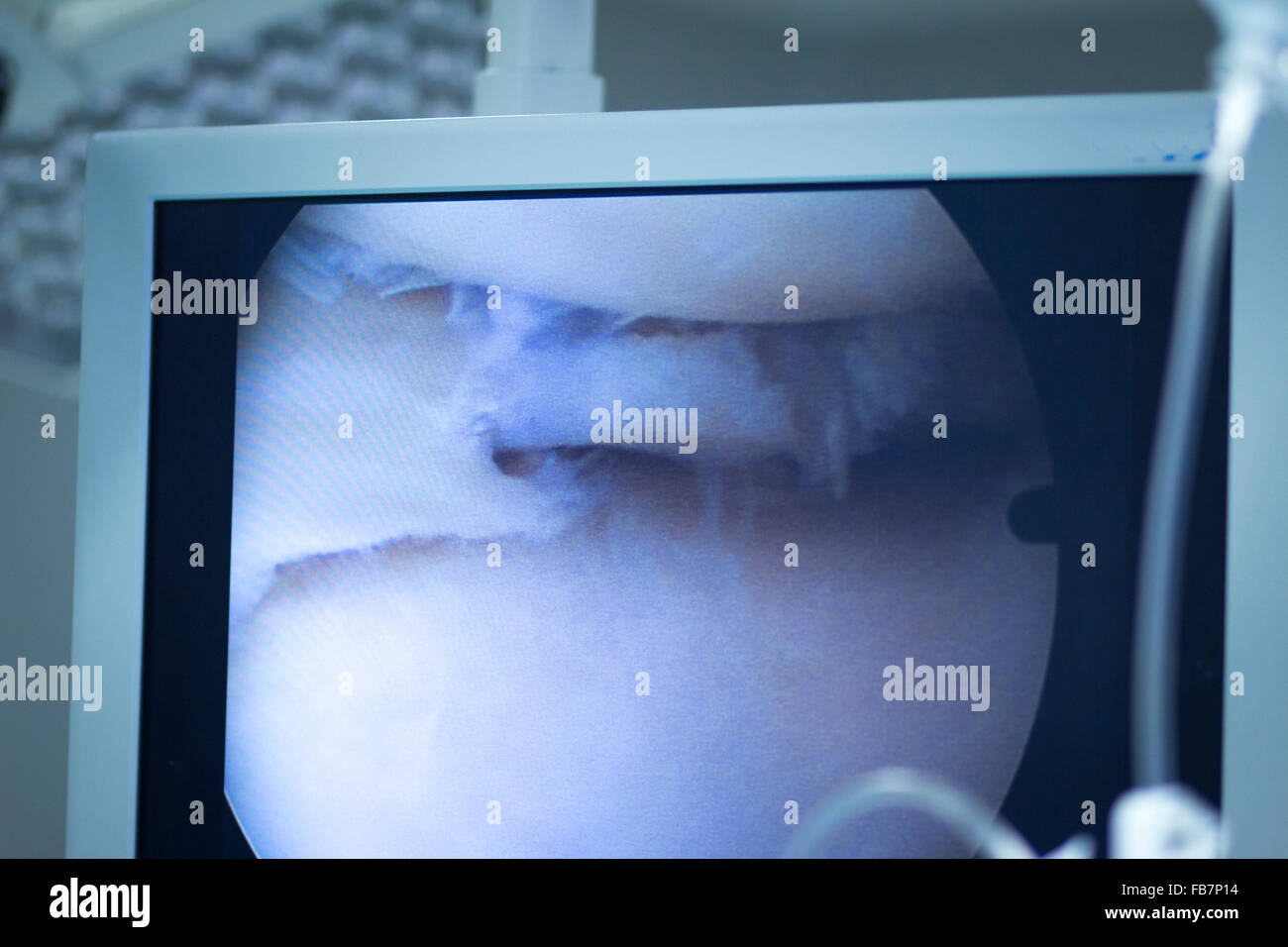 Hospital keyhole micro surgery arthroscopy operation screen showing ...