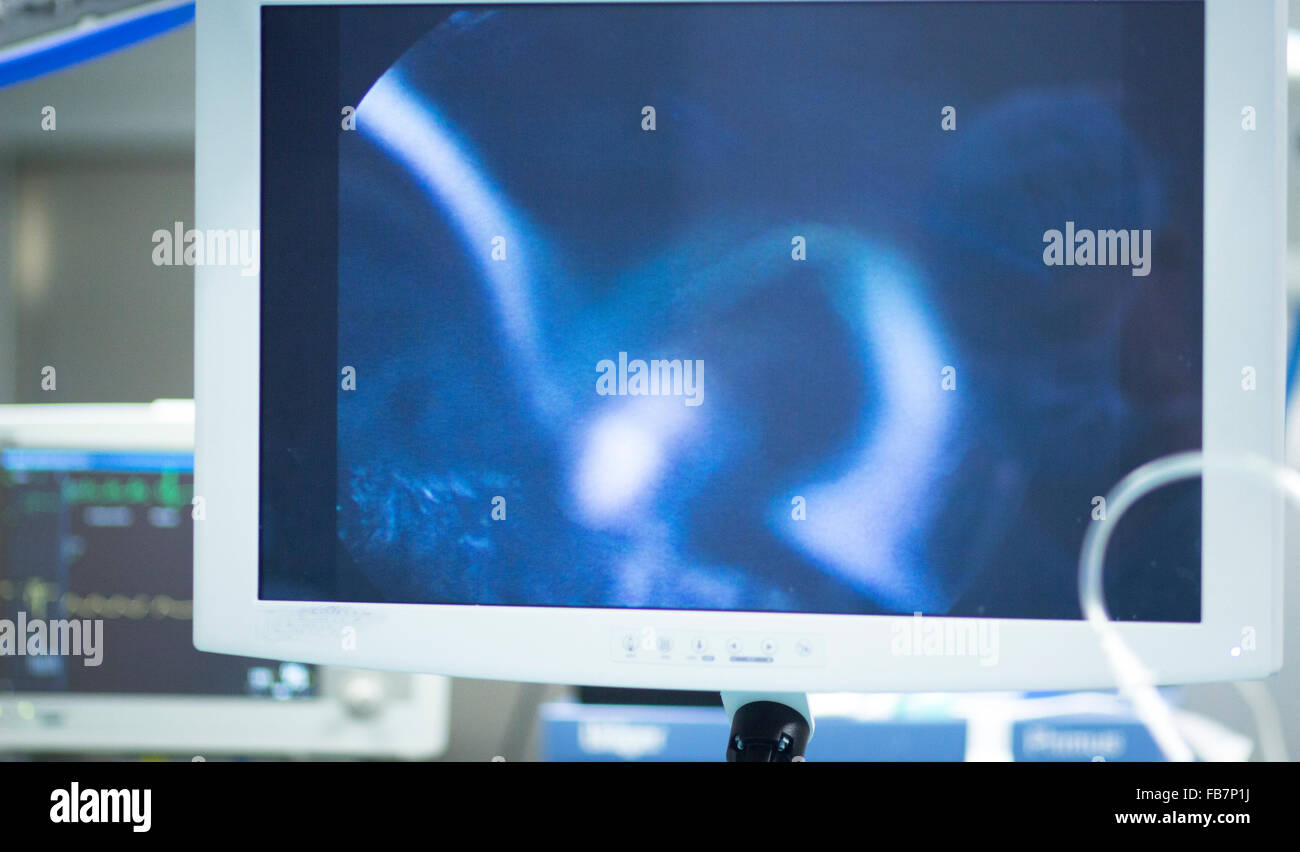 Hospital keyhole micro surgery arthroscopy operation screen showing ...